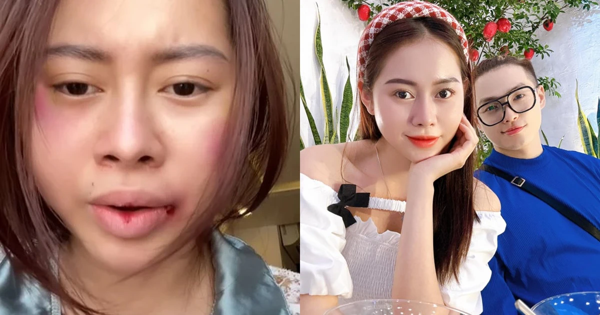 TikToker Việt Phương Thoa "cầu cứu" vì bị bạn trai "tác động" bầm tím ...